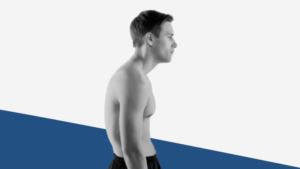 Kifosis: Ketahui Gejala, Penyebab dan Cara Penanganannya