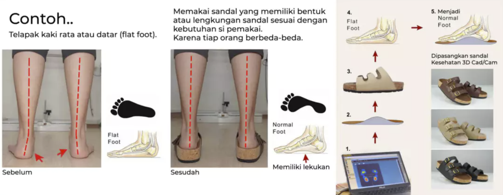 Sandal Kesehatan Custom CAD/CAM - Spine Clinic Family Holistic