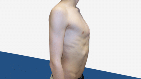 Pectus Carinatum: Dikenal Sebagai Pigeon Chest / Dada Burung