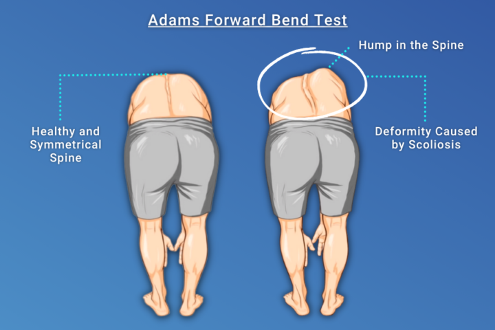 Kenali Adam's Forward Bend Test, Metode Deteksi Skoliosis Paling Mudah ...