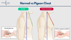 Pectus Carinatum: Dikenal Sebagai Pigeon Chest / Dada Burung