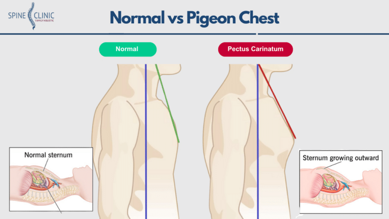 Pectus Carinatum: Dikenal Sebagai Pigeon Chest / Dada Burung