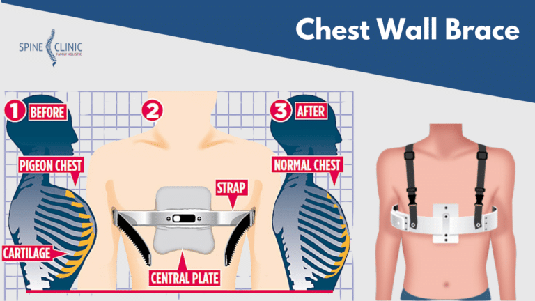 Pectus Carinatum: Dikenal Sebagai Pigeon Chest / Dada Burung
