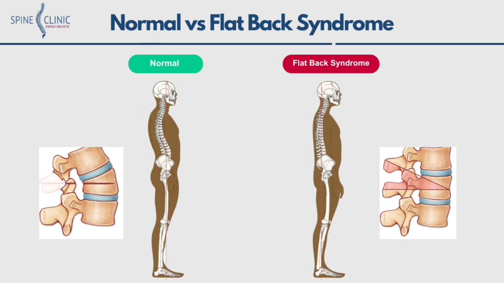 Flat Back Syndrome: Ketahui Gejala, Penyebab, dan Penanganan