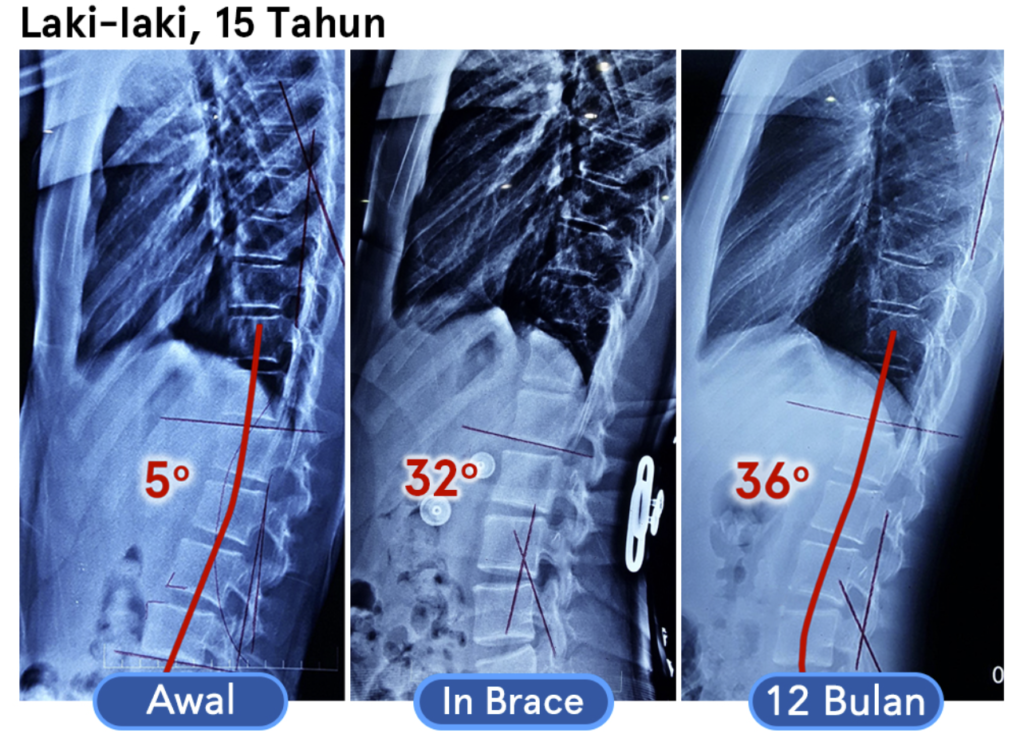 Brace GBW - Spine Clinic Family Holistic