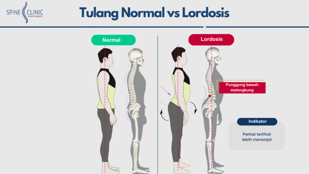 Lordosis: Ketahui Ciri Ciri, Penyebab, dan Cara Menyembuhkannya
