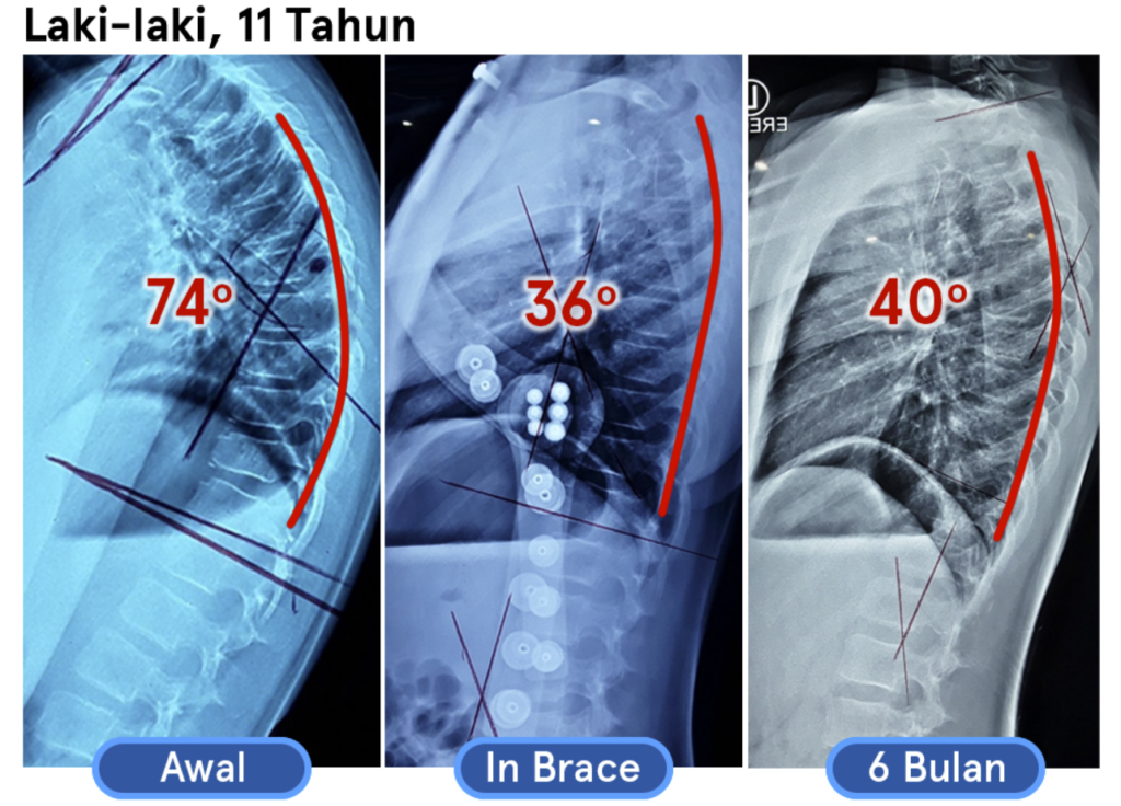 Brace GBW - Spine Clinic Family Holistic