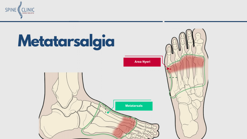9 Cara Ampuh Menangani Telapak Kaki Sakit atau Metatarsalgia