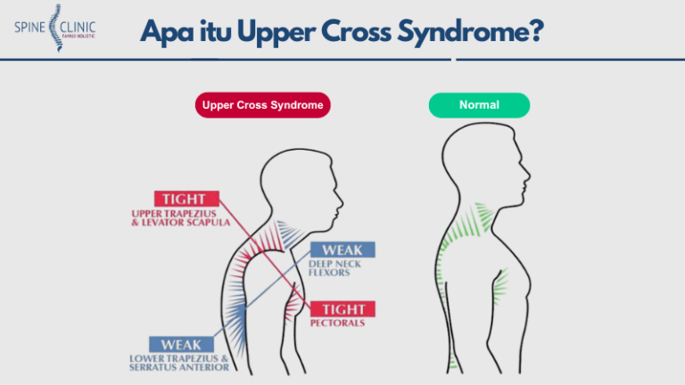 Upper Cross Syndrome - Akibat Dari Postur Buruk Berkepanjangan