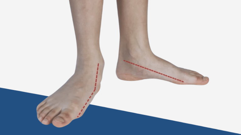 Flat Foot - Ketahui Penanganan yang Tepat Dari Pakar Kaki