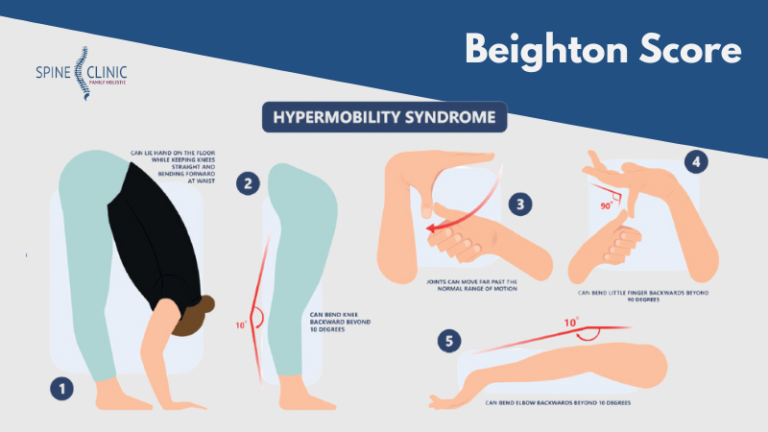 Joint Hypermobility Syndrome - Fleksibilitas Berlebihan Pada Sendi