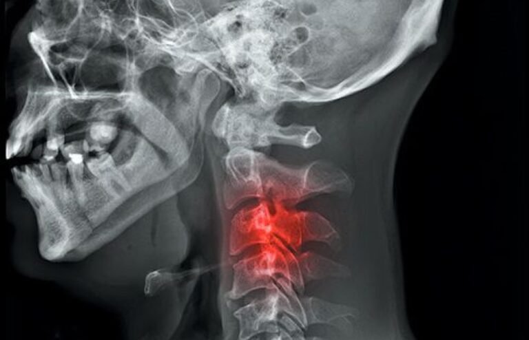 Cervical Syndrome - Penyebab, Gejala, dan Cara Penanganan