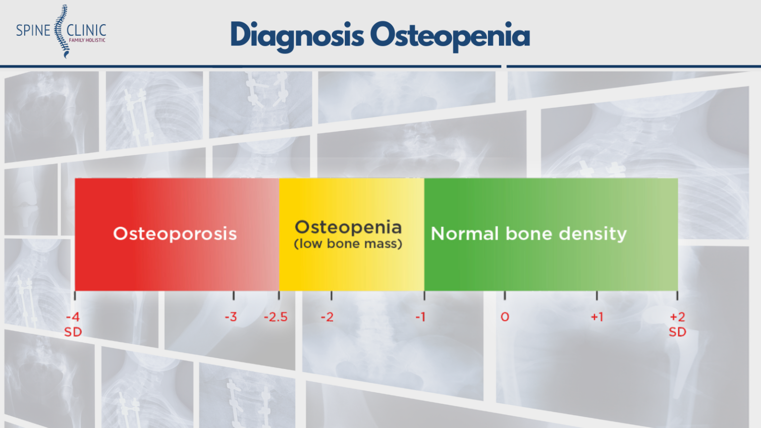 Apa itu Osteopenia? Penyebab, Gejala, dan Penanganan