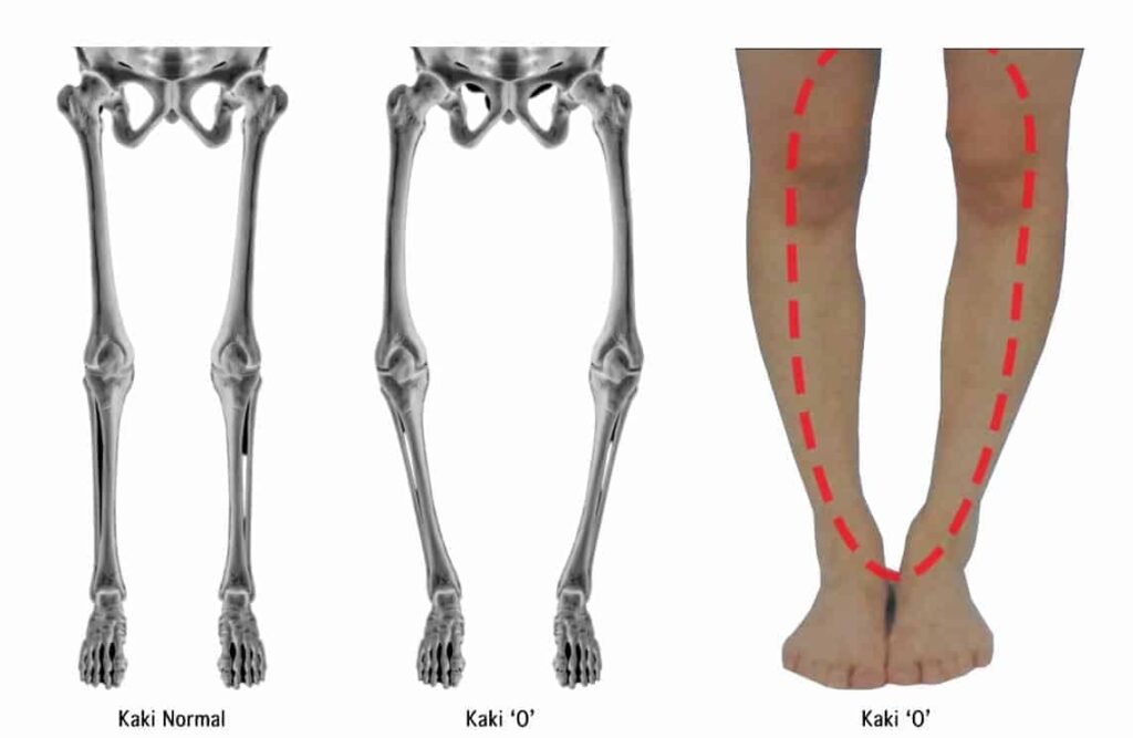 Bagaimana Proses Perkembangan Kaki Anak yang Normal? - Spine Clinic ...
