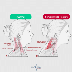Forward Head Posture: Latihan untuk Text Neck Syndrome
