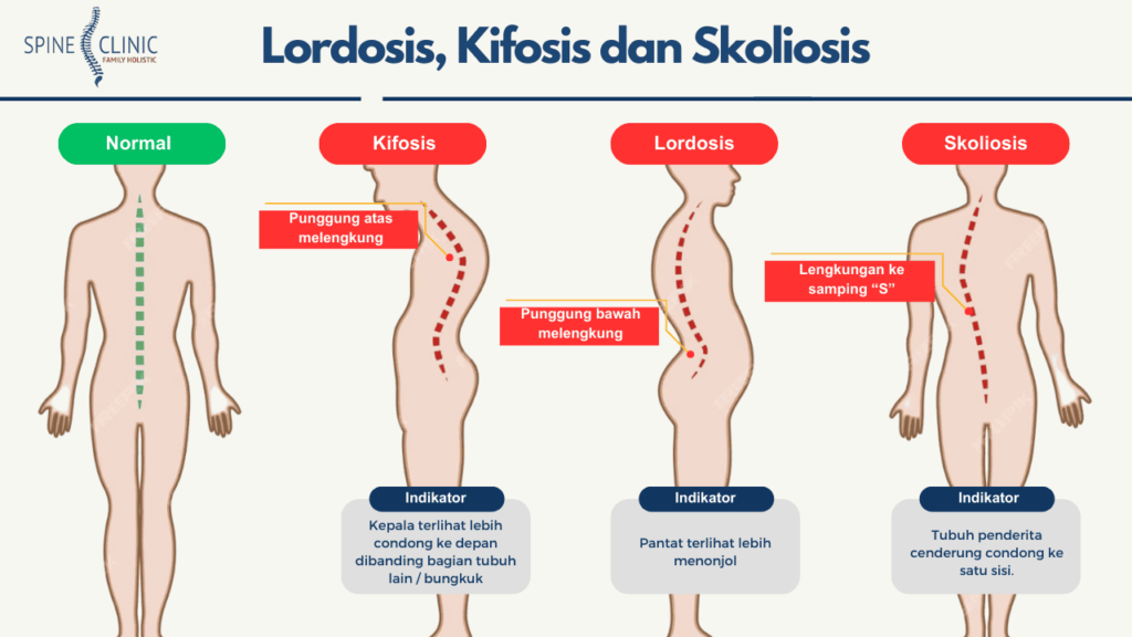 Perbedaan Skoliosis, Lordosis, dan Kifosis Lengkap & Solusinya