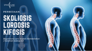 Perbedaan Skoliosis, Lordosis, dan Kifosis Lengkap & Solusinya