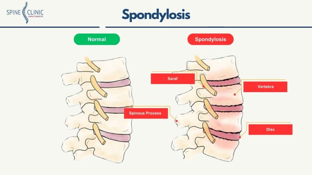 Spondilosis - Spine Clinic Family Holistic