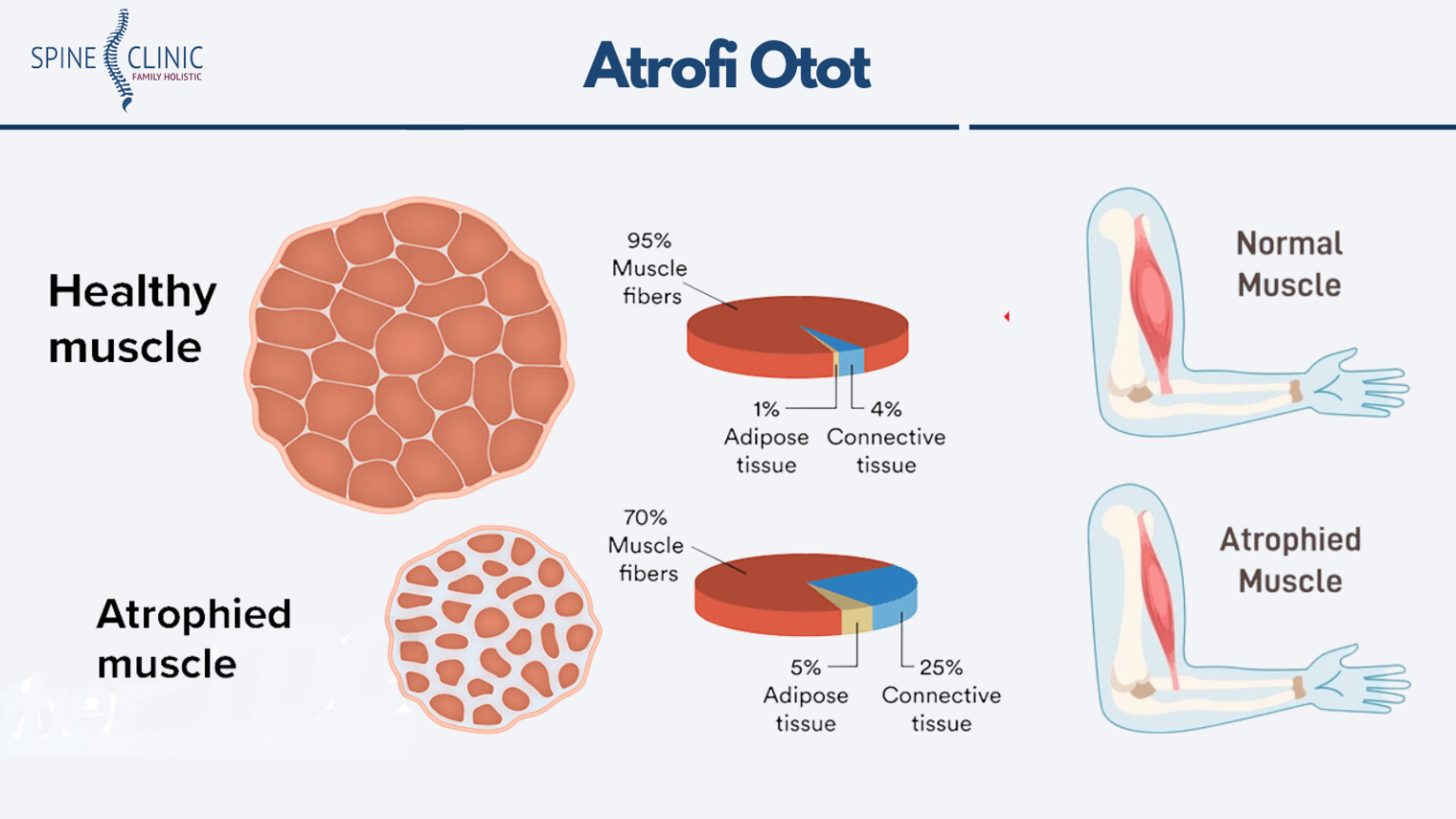 Atrofi Otot: Atasi Penyusutan Otot Dengan Latihan dan Nutrisi