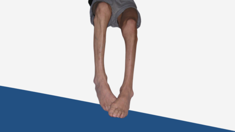 Atrofi Otot: Atasi Penyusutan Otot Dengan Latihan dan Nutrisi