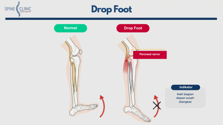 Begini Cara Menyembuhkan Drop Foot Secara Natural di Rumah!