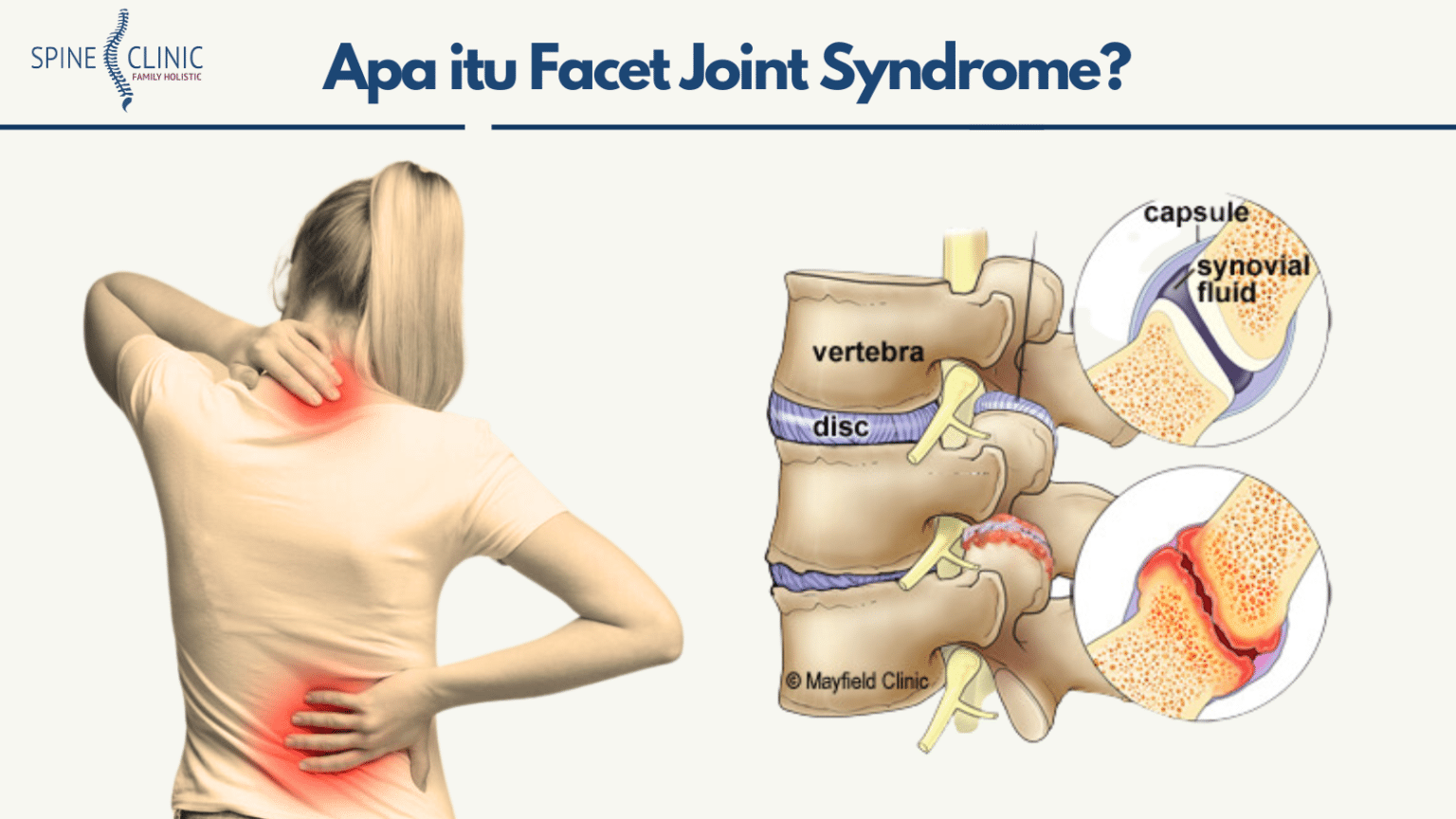 Facet Joint Syndrome: Penyebab, Gejala, dan Penanganan