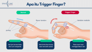 Trigger Finger - Inilah 7 Solusi Jari Kaku & Susah Digerakkan