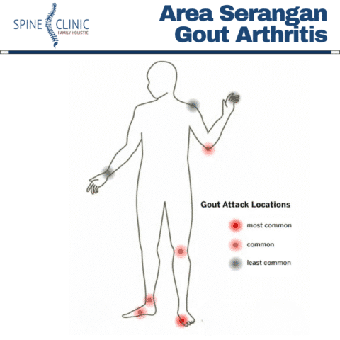 Gout Arthritis: Penyebab, Gejala, Obat, dan Pantangan Lengkap