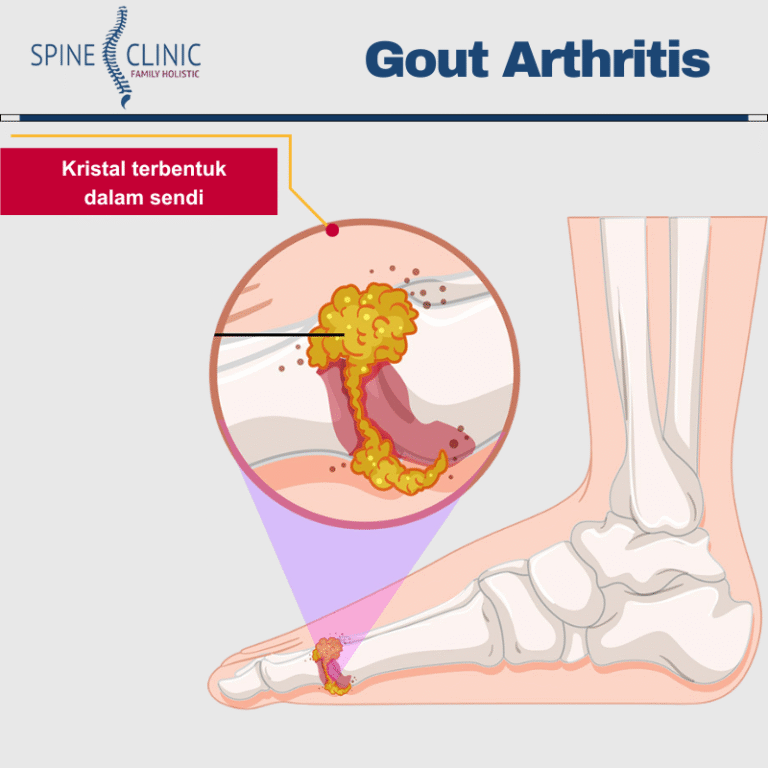 Gout Arthritis: Penyebab, Gejala, Obat, dan Pantangan Lengkap