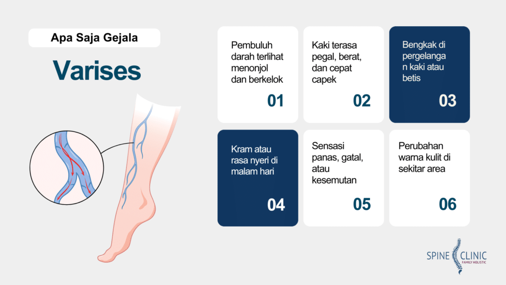 Varises: Gejala, Penyebab, & Cara Mengobati Menurut Ahli Medis